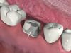 What Is Dental Crown Core Buildup? - Know Its Purpose